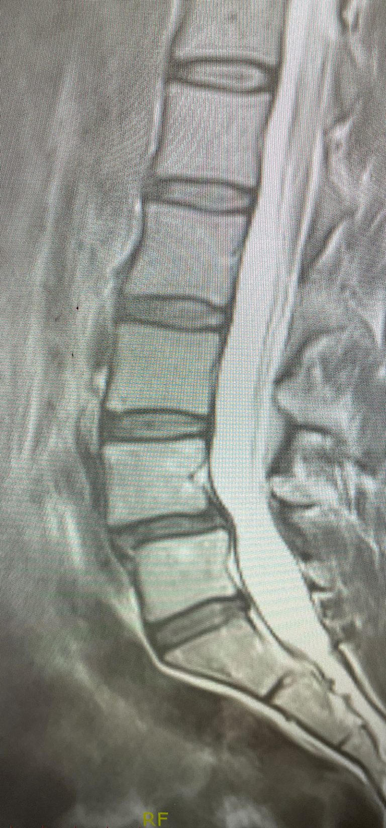 Transitional Lumbar Segment | NSPC Brain & Spine Surgery